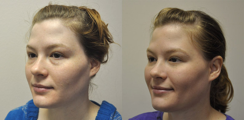 Blepharoplasty Eyelid Eye Lift Surgery | Plastic Cosmetic Surgery Tyler ...